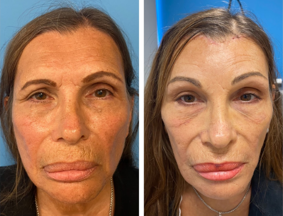 At What Age Does Your Face Change Most? At What Age Does Your Face Change Most?